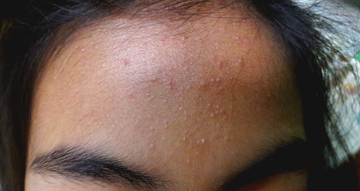 What does Fungal Acne Look Like? - Dr. Eddie's Happy Cappy