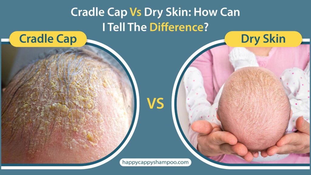 Cradle Cap Vs Dry Skin: Differences, Symptoms, and Treatment