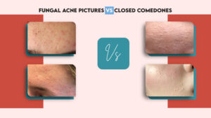 Fungal Acne VS Closed Comedones: What’s the Difference? - Happy Cappy
