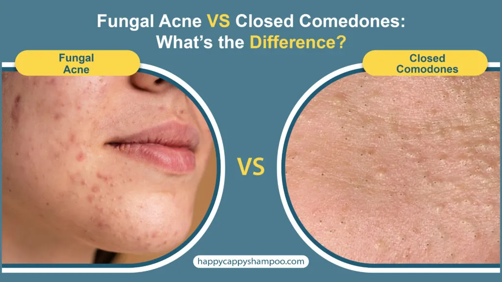 Fungal Acne Vs Closed Comedones Whats The Difference Happy Cappy