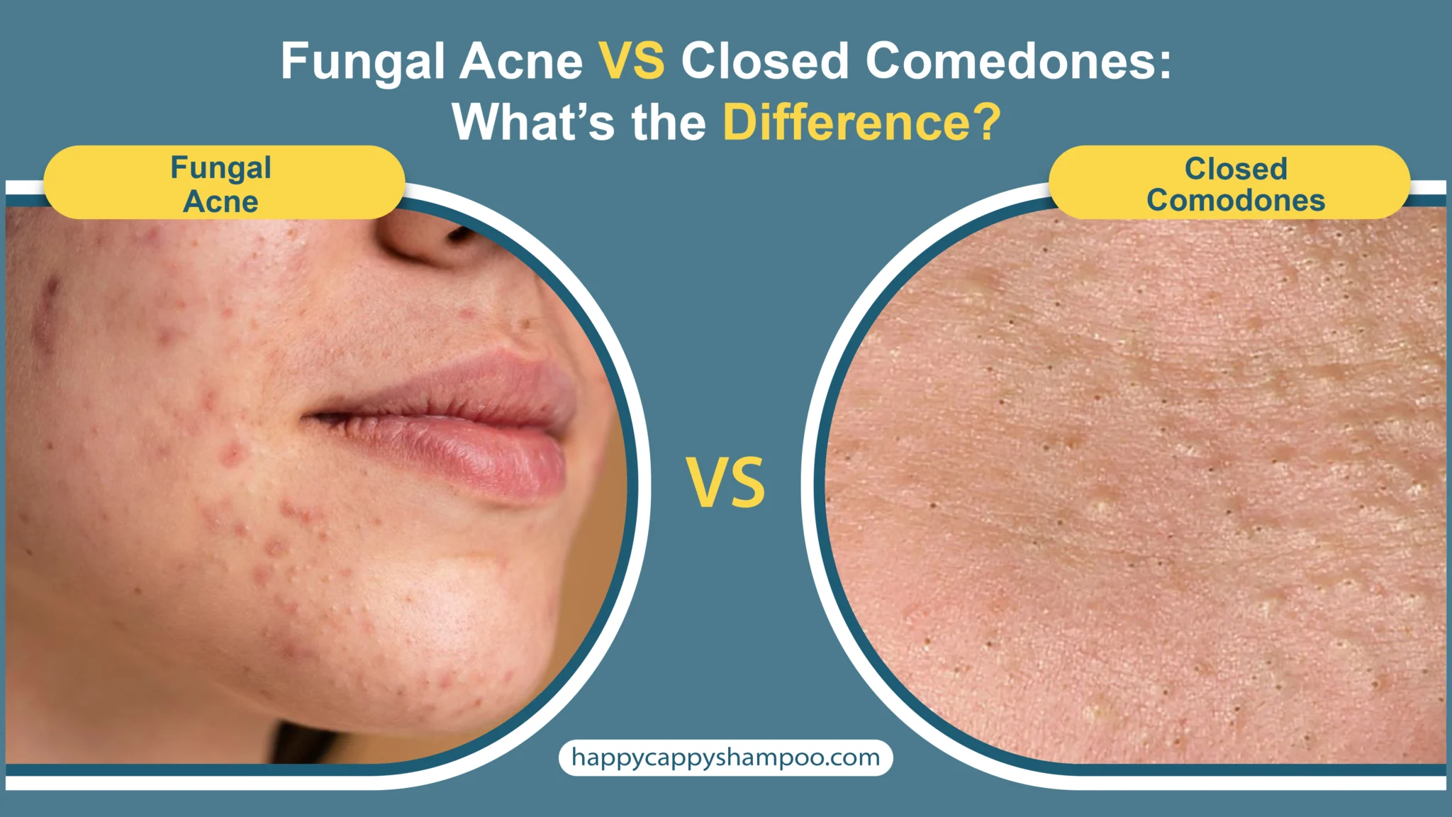 Fungal Acne VS Closed Comedones: What’s the Difference? - Happy Cappy