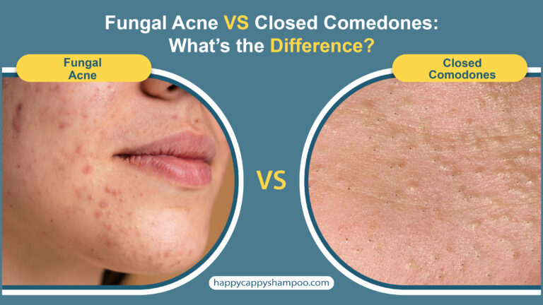 Fungal Acne VS Closed Comedones: What’s the Difference? - Happy Cappy