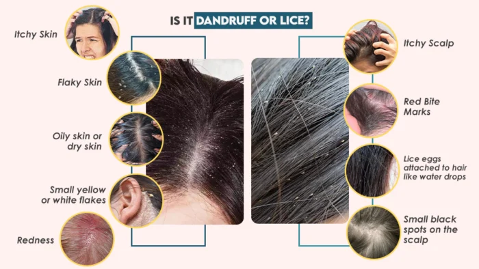 Lice Eggs Vs. Dandruff: What’s the Difference? - Happy Cappy