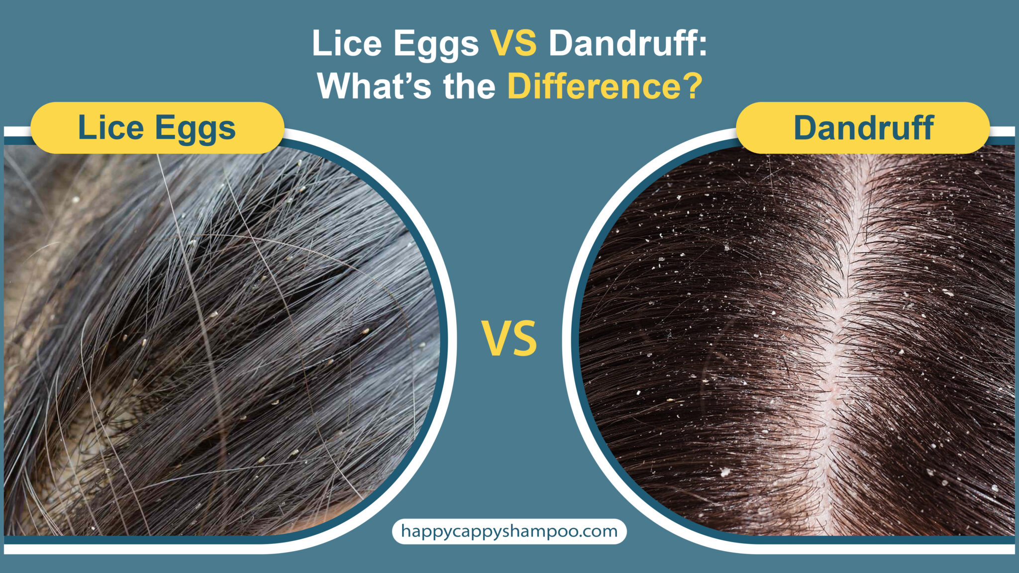 Lice Eggs Vs. Dandruff: What’s the Difference? - Happy Cappy