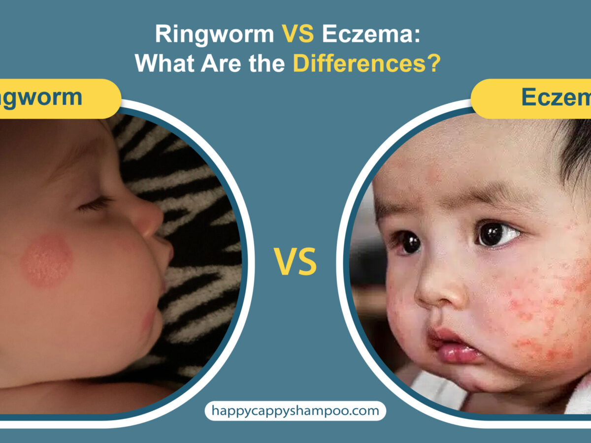 Ringworm In Children Images Ringworm Is It Caused By A Worm? Qoctor