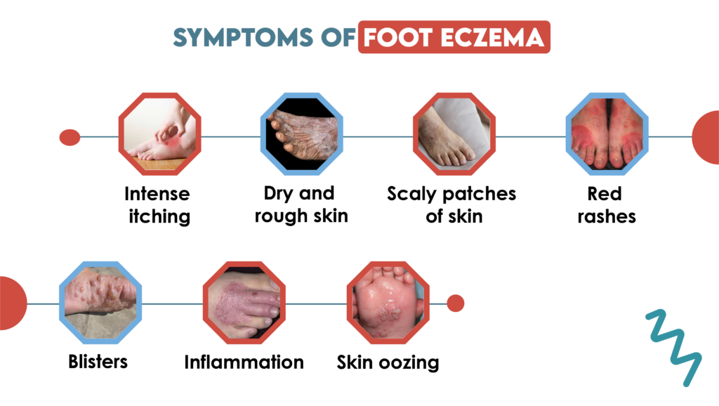 Is Eczema the Same as Athlete’s Foot? - Happy Cappy