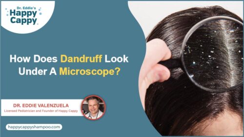 Dandruff Flakes Under Microscope: Symptoms, Causes and Treatment