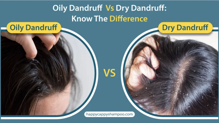Oily Dandruff Vs Dry Dandruff: Know The Difference