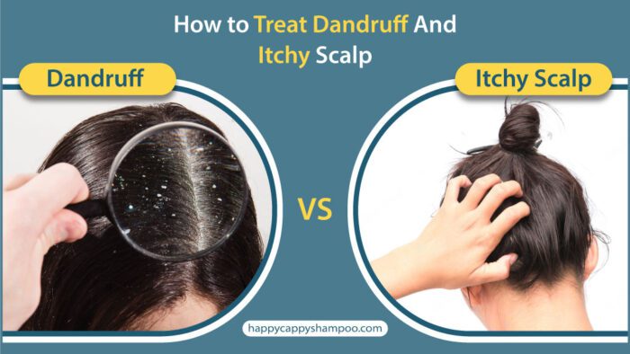How to Treat Dandruff And Itchy Scalp - Dr. Eddie's Happy Cappy