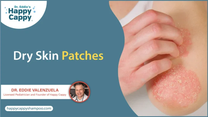 Dry Skin Patches : Causes, Symptoms and Treatments - Dr. Eddie's Happy ...