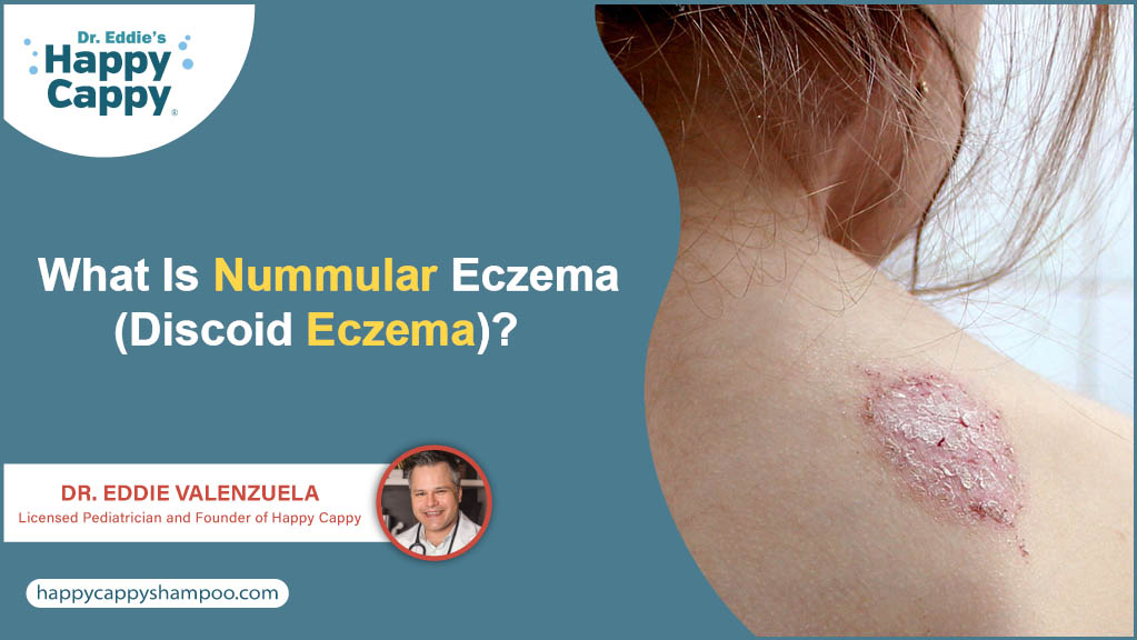 What Is Nummular Eczema (Discoid Eczema)? - Dr. Eddie's Happy Cappy