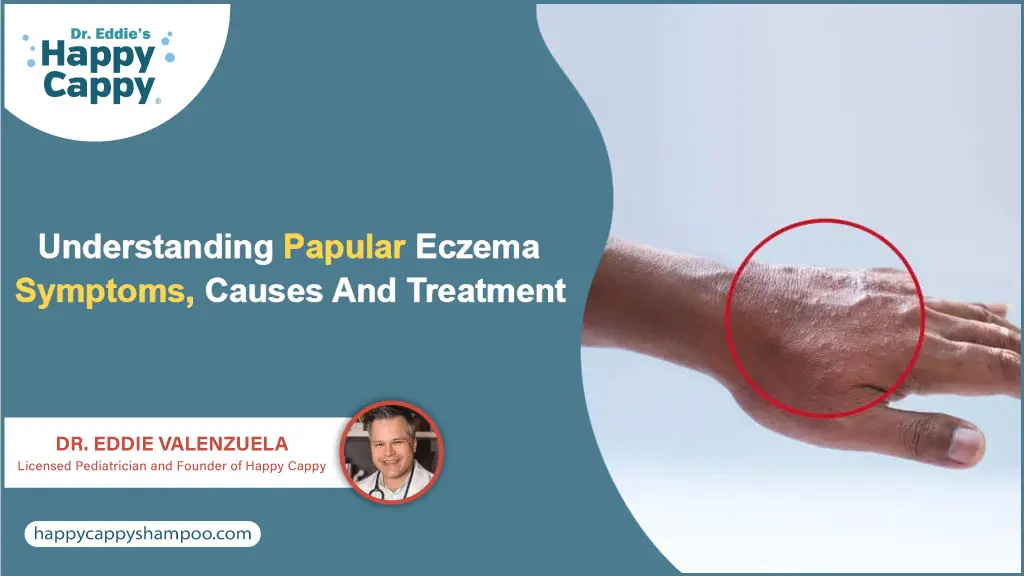 Papular Eczema: Symptoms and Treatment Options