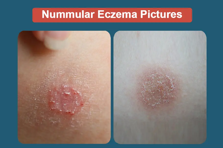 What Is Nummular Eczema (Discoid Eczema)? - Dr. Eddie's Happy Cappy