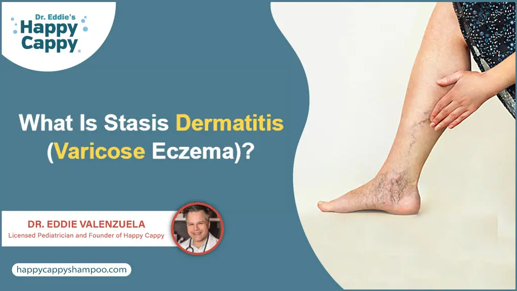 What Is Stasis Dermatitis (Varicose Eczema)? - Dr. Eddie's Happy Cappy