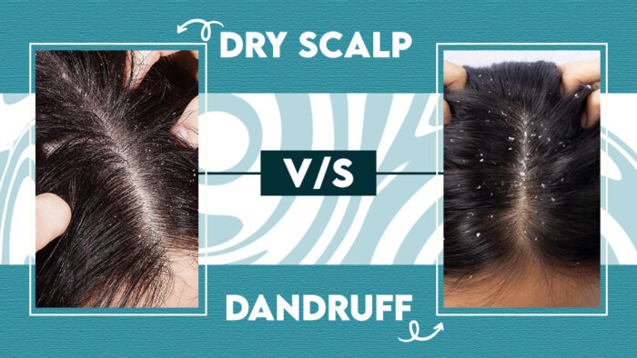 What is Dandruff, its Symptoms, and How to Get Rid of it?