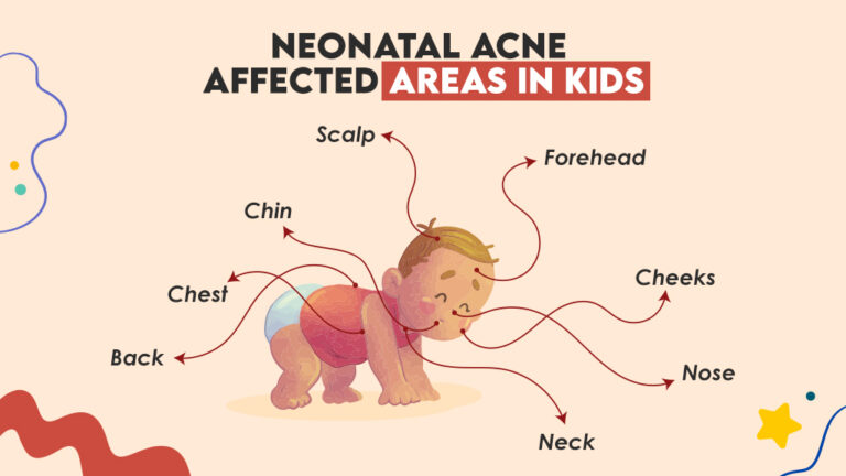 Neonatal Acne (Baby Acne): Symptoms, Causes, and Treatment