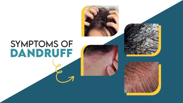 What Causes Dandruff: Symptoms & Causes | Happy Cappy