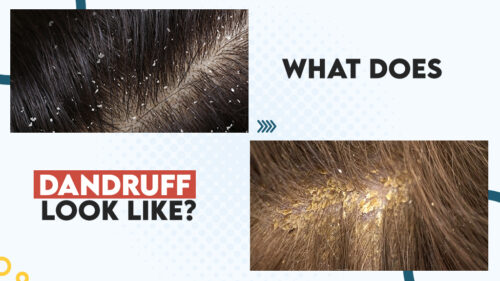 What is Dandruff, its Symptoms, and How to Get Rid of it?