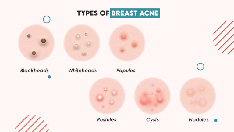 What Causes Pimple on Breast? Is It Breast Cancer? - Happy Cappy
