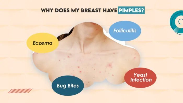 What Causes Pimple on Breast? Is It Breast Cancer? - Happy Cappy