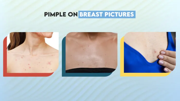 What Causes Pimple on Breast? Is It Breast Cancer? - Happy Cappy