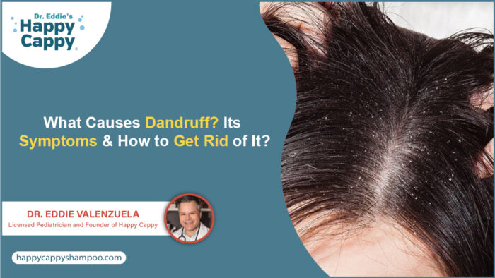 What is Dandruff, its Symptoms, and How to Get Rid of it?