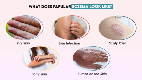 Papular Eczema: Symptoms and Treatment Options