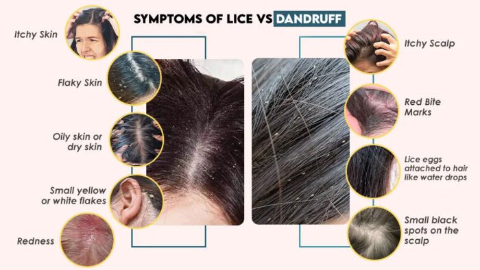 Lice Eggs Vs. Dandruff: What’s the Difference? - Happy Cappy