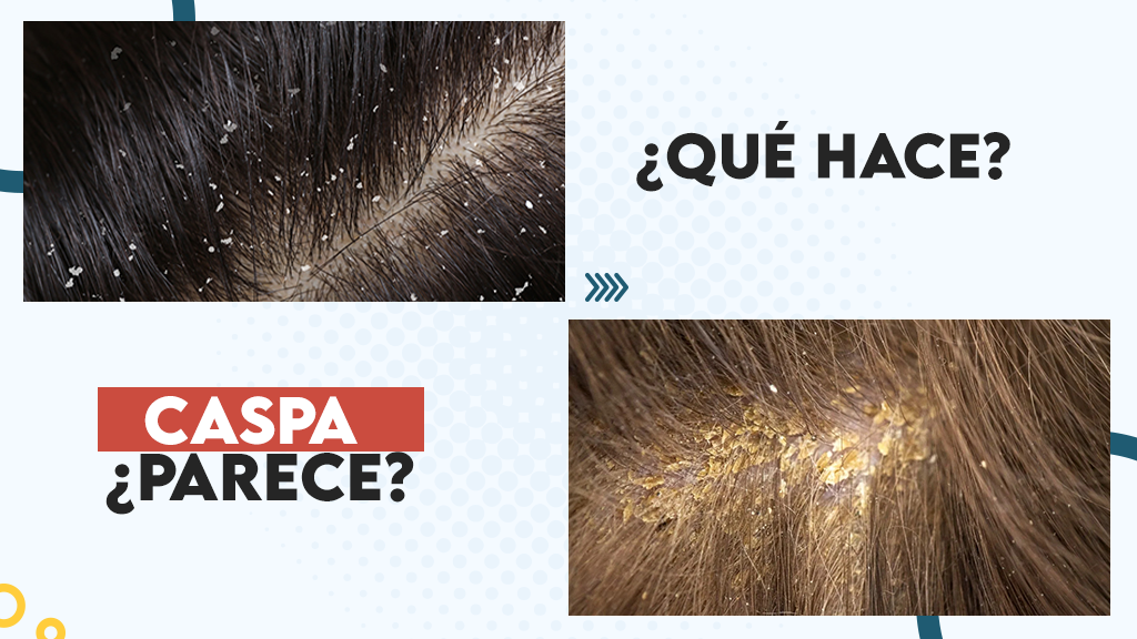 ¿Qué causa la caspa, sus síntomas y cómo deshacerse de ella?