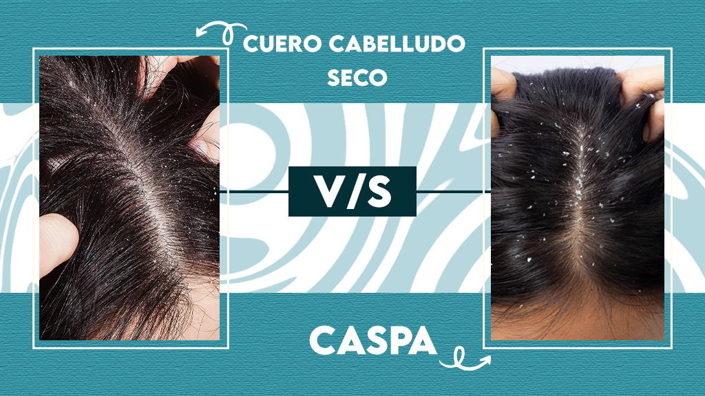 ¿Qué causa la caspa, sus síntomas y cómo deshacerse de ella?