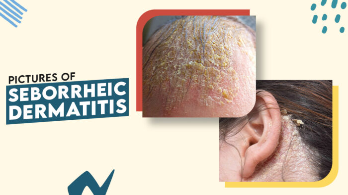 What is Seborrheic Dermatitis? Symptoms, Causes & Treatment
