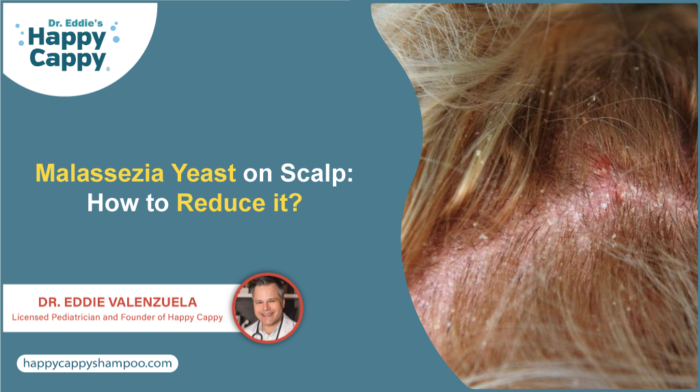 Malassezia Yeast on Scalp: How to Reduce it? - Happy Cappy
