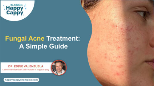 Fungal Acne Treatment: A Simple Guide - Happy Cappy