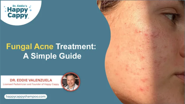 Fungal Acne Treatment: A Simple Guide - Happy Cappy