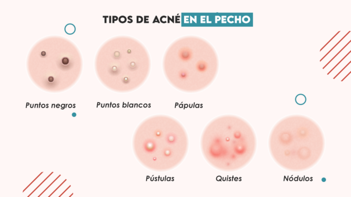 ¿Qué causa los granos en el pecho? ¿Es cáncer de mama?