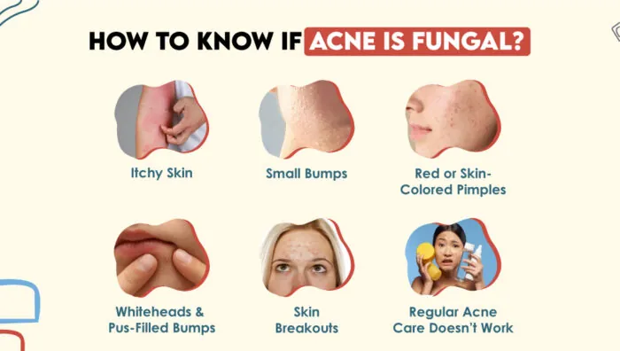 Fungal Acne vs Hormonal Acne: Know the Difference - Happy Cappy