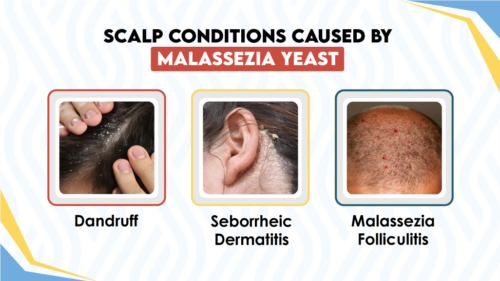 Malassezia Yeast on Scalp: How to Reduce it? - Happy Cappy