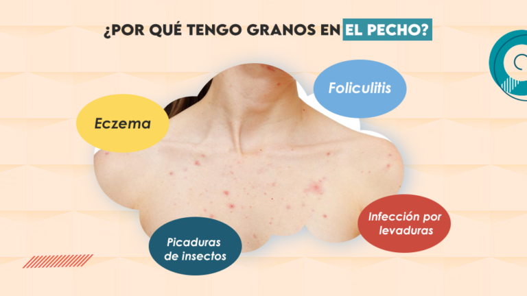 ¿Qué causa los granos en el pecho? ¿Es cáncer de mama?