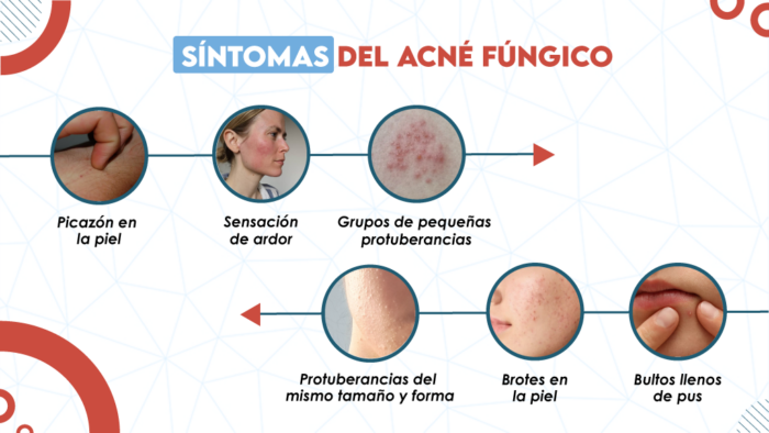 Tratamiento del acné fúngico: una guía sencilla - Happy Cappy