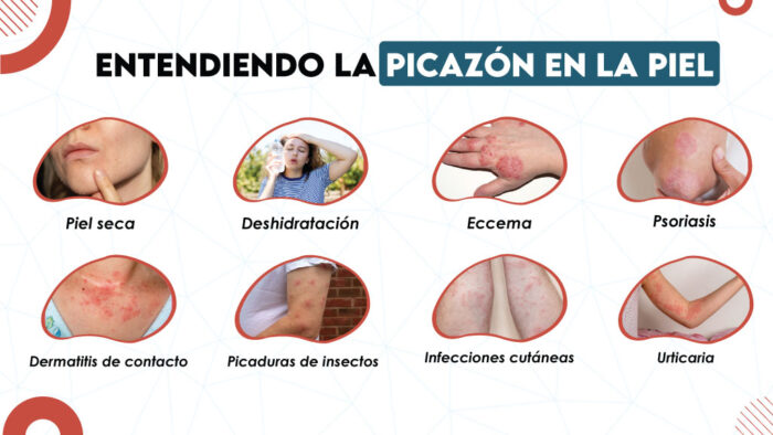 La mejor crema para la picazón en la piel - Happy Cappy