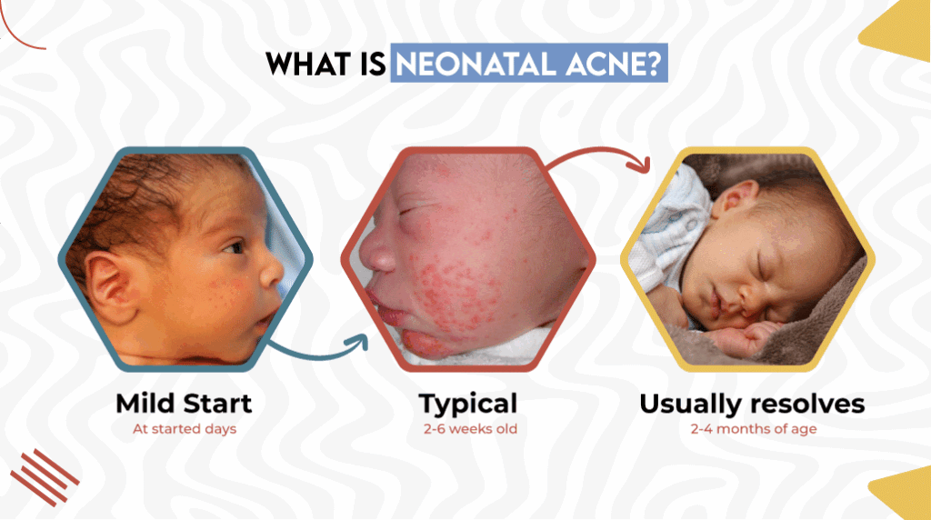 Neonatal Acne (Baby Acne): Symptoms, Causes, and Treatment